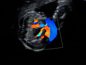 Quintero Staging for TTTS - The Fetal Institute